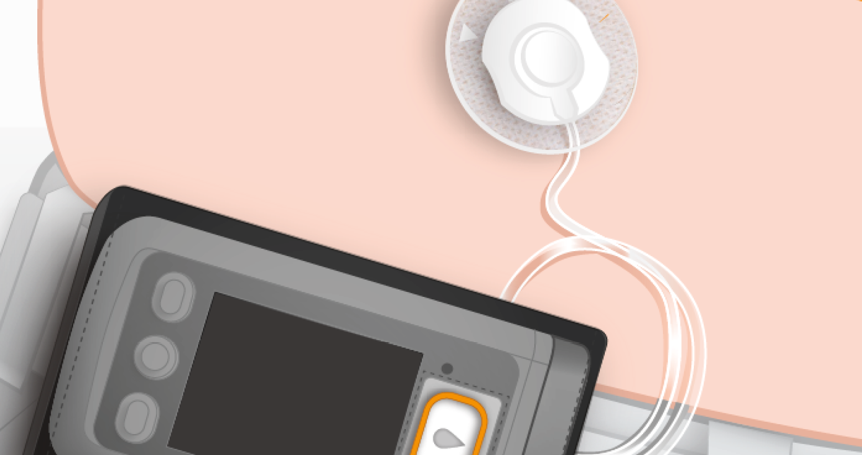 The correct injection site for subcutaneous apomorphine therapy